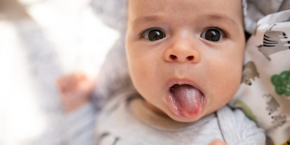 Tongue Tie in Infants: Understanding Its Impact on Speech and Feeding